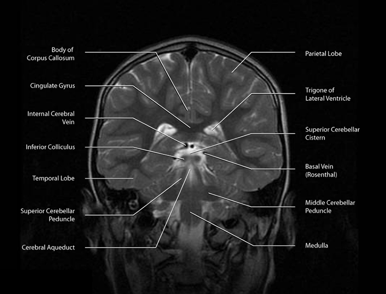 Cerebellar Peduncles Mri